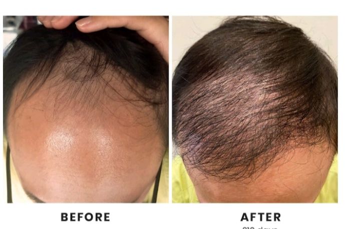 Cangkok Rambut Jadi Solusi Efektif Atasi Kebotakan – Hidupgaya.co